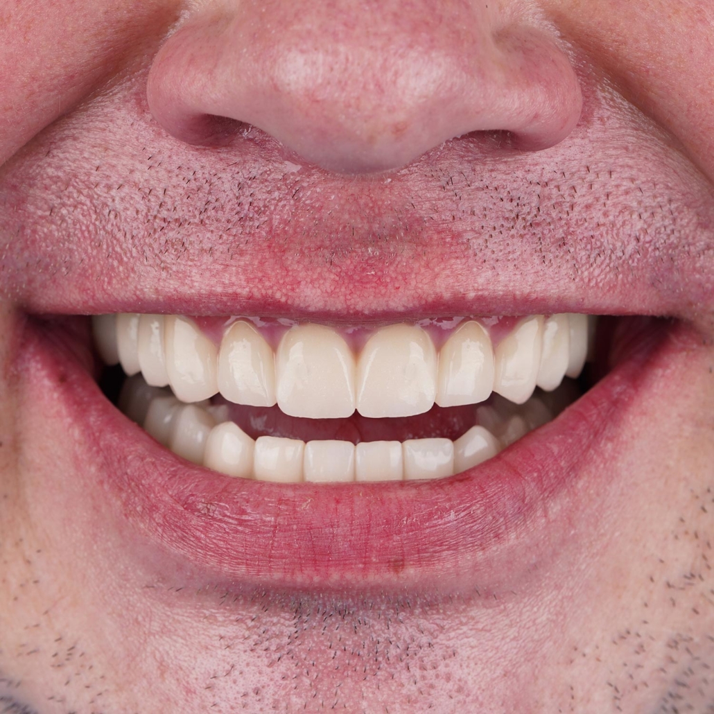 Monolithic Crown - Istadental